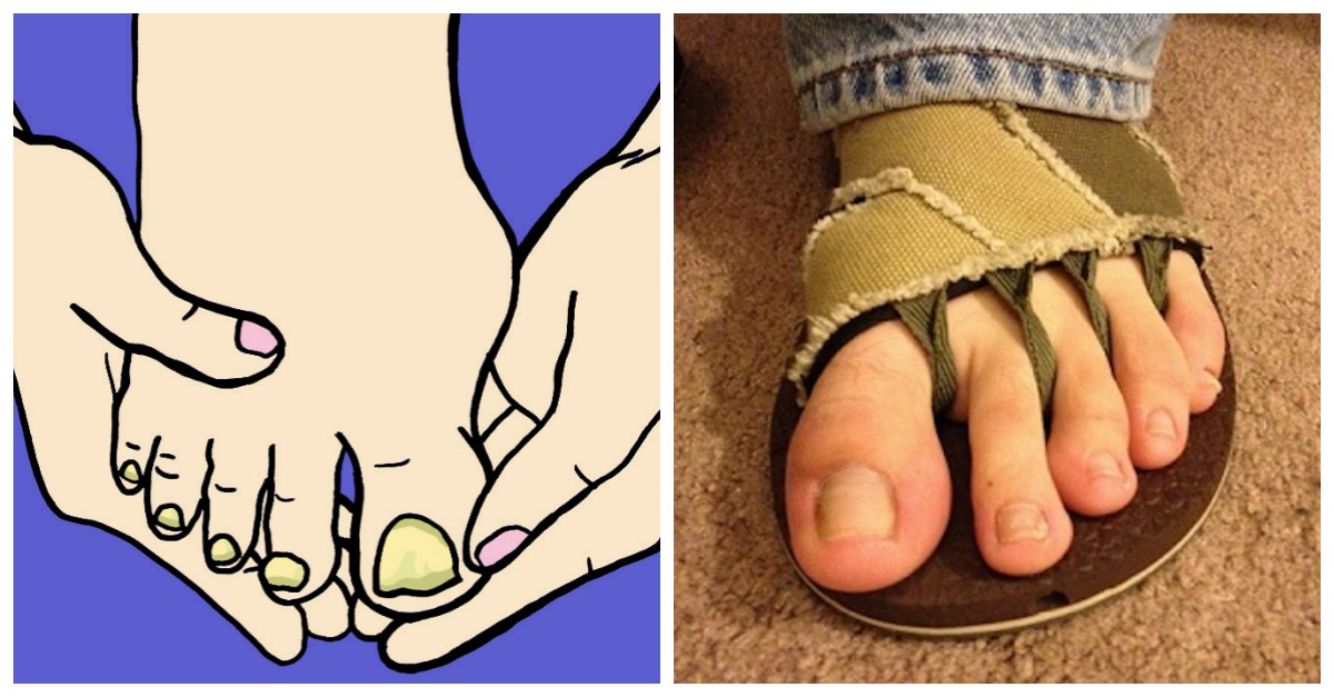 Toenail Fungus: 6 Signs You Should Never Ignore | LittleThings.com