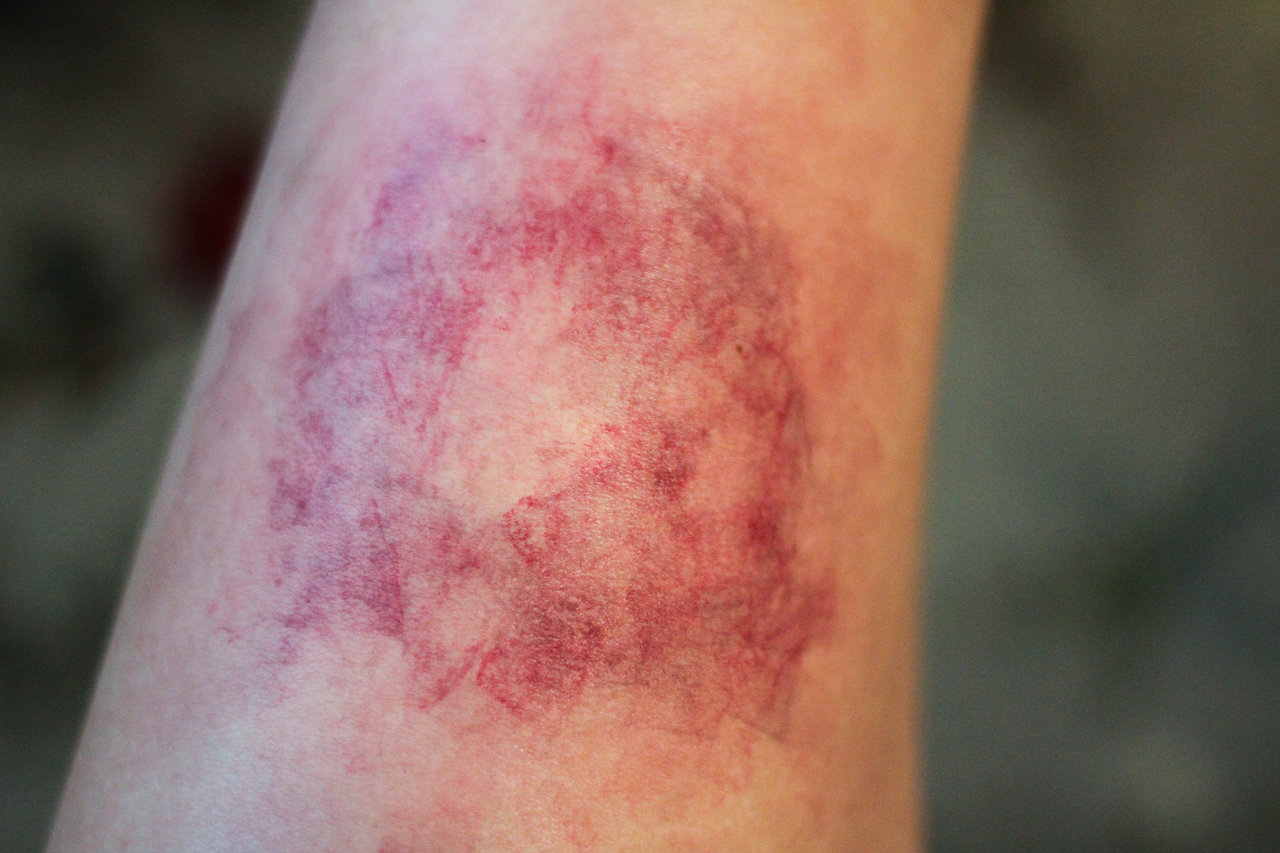 Learn How To Tell And Heal The 5 Different Shades Of Bruises ...