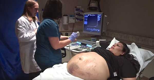 Moms Quintuplet Pregnancy Belly Is Covered With Bruises