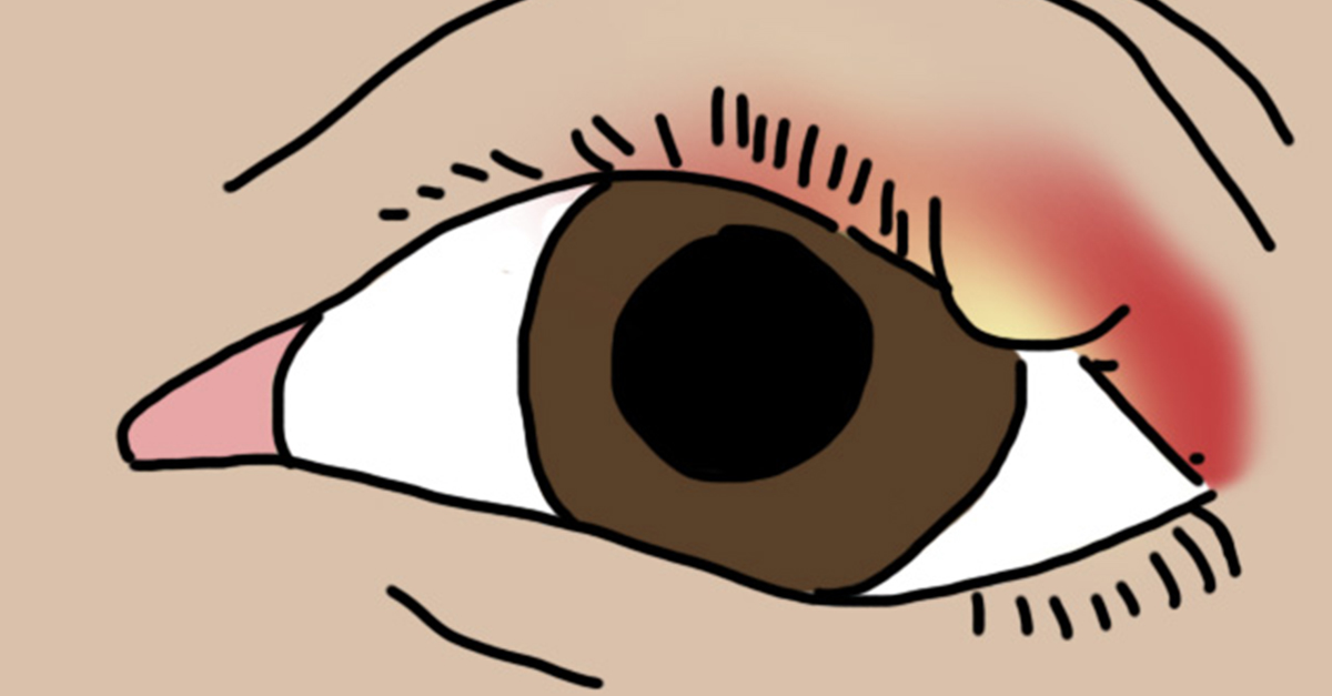 Experts Say Doing THIS Can Get Rid Of Painful Styes Quickly ...