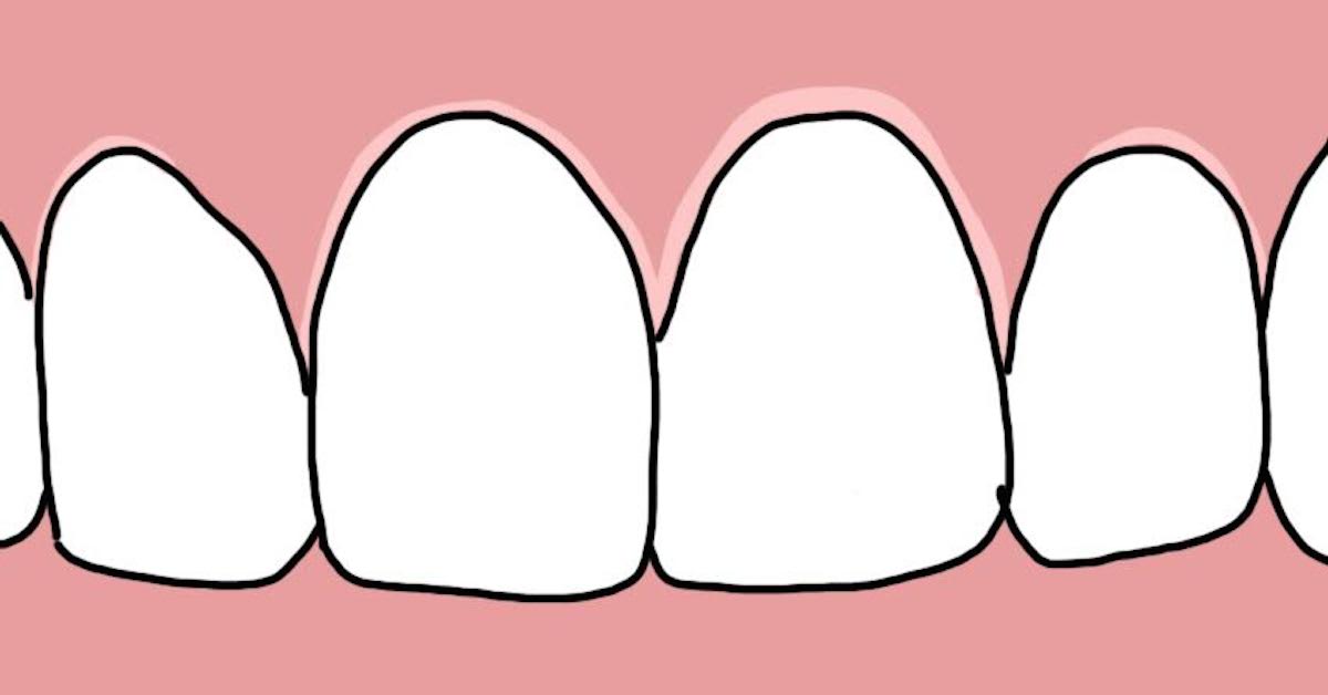 These Shiny Red Rings Could Mean Trouble For Your Gums. I Had No Idea ...