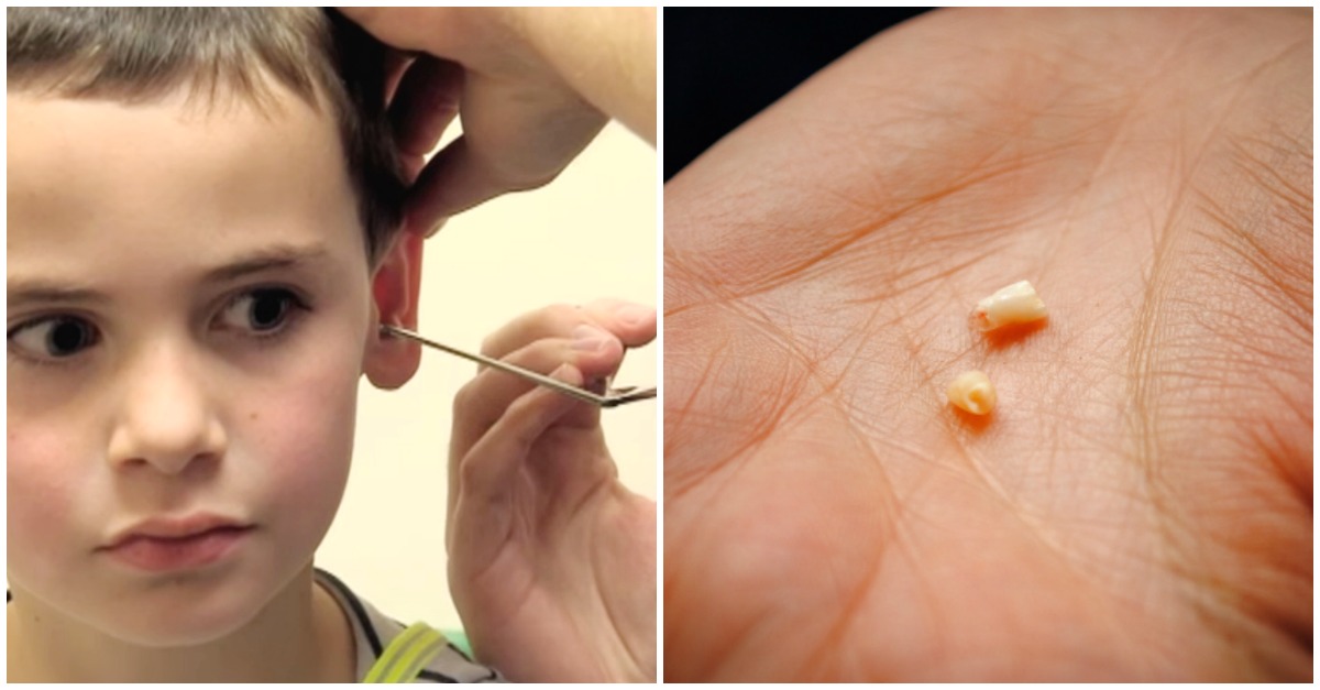 11 Of The Strangest And Grossest Things Doctors Have Found Inside Their ...