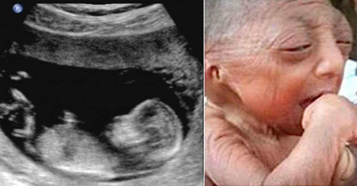 Boy With Rare Condition Looks Like Old Man | LittleThings.com