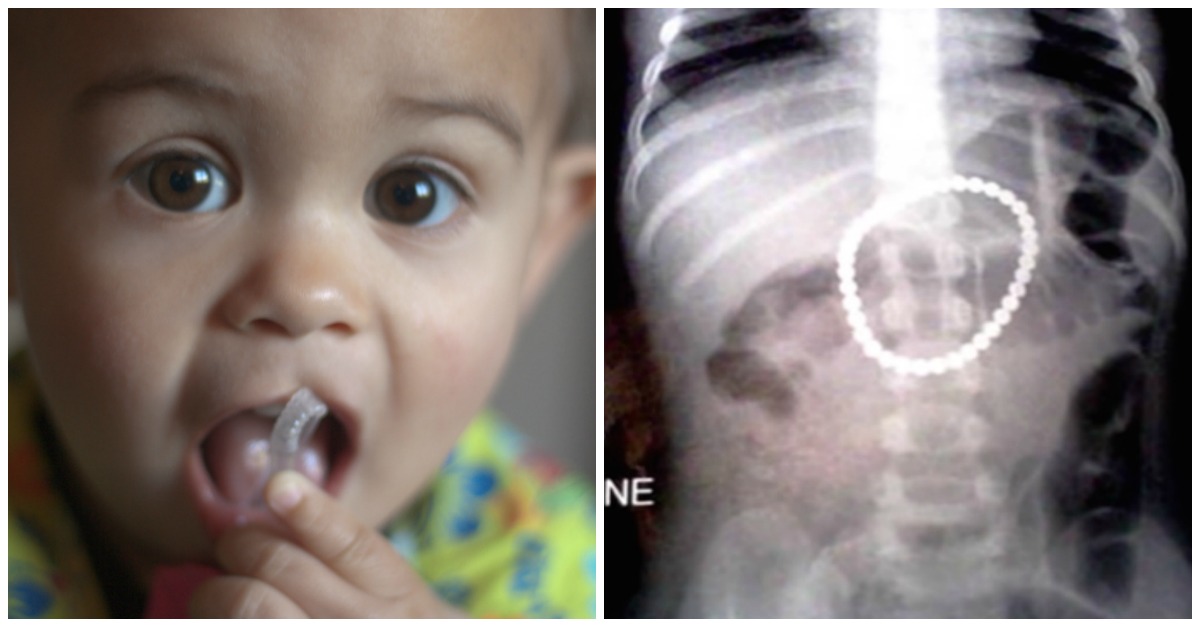 9 Of The Strangest Things Kids Have Swallowed And Lived To Tell The ...