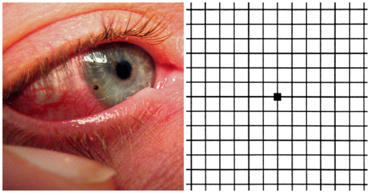 This Test Can Tell If You Damaged Your Eyes In The Eclipse ...