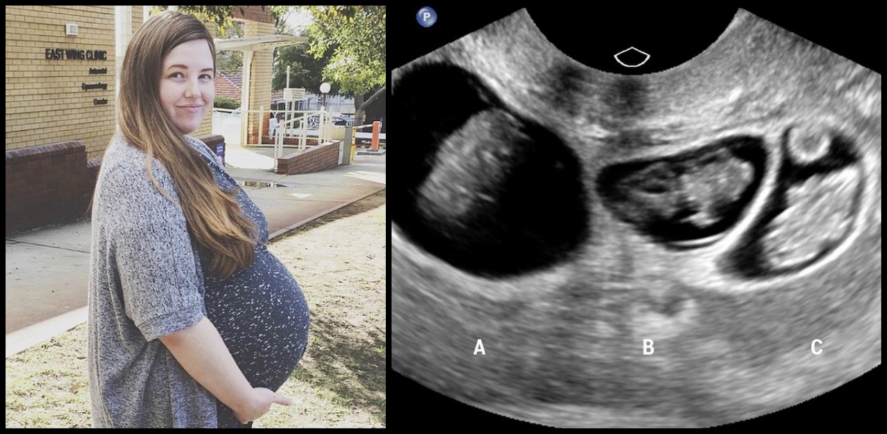 Triplets In The Womb