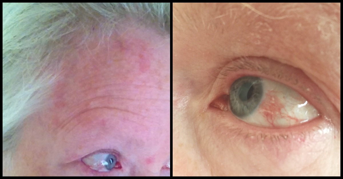 The Symptoms Of Shingles In Adults You Need To Look Out For ...