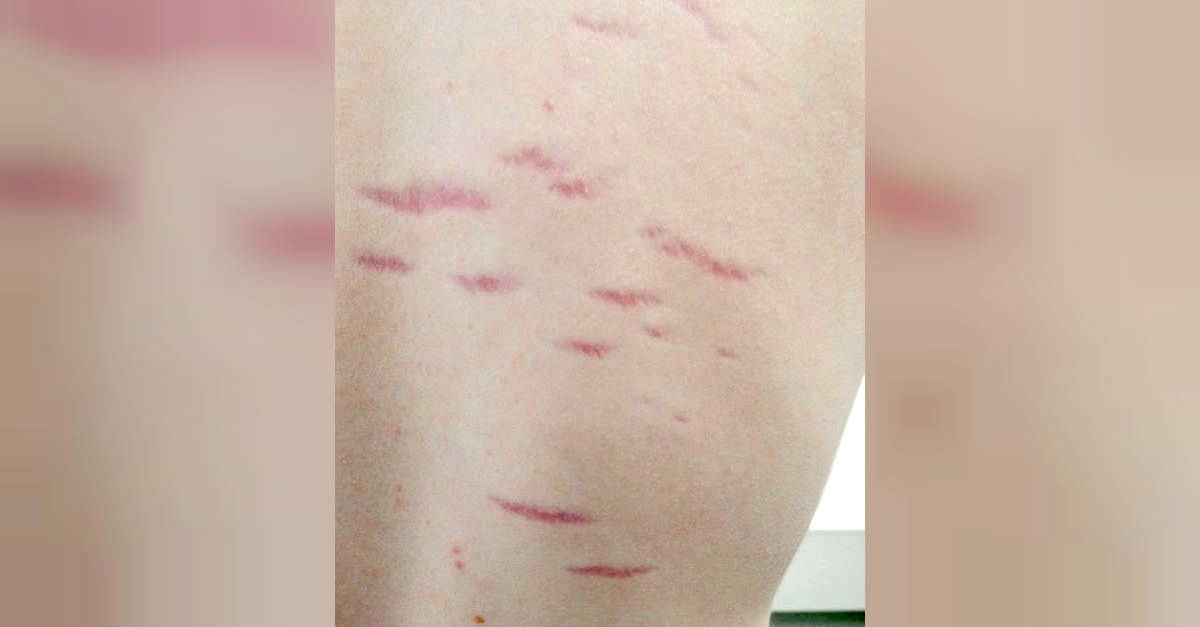 10 Surprising Things You Didn’t Know About Your Stretch Marks ...