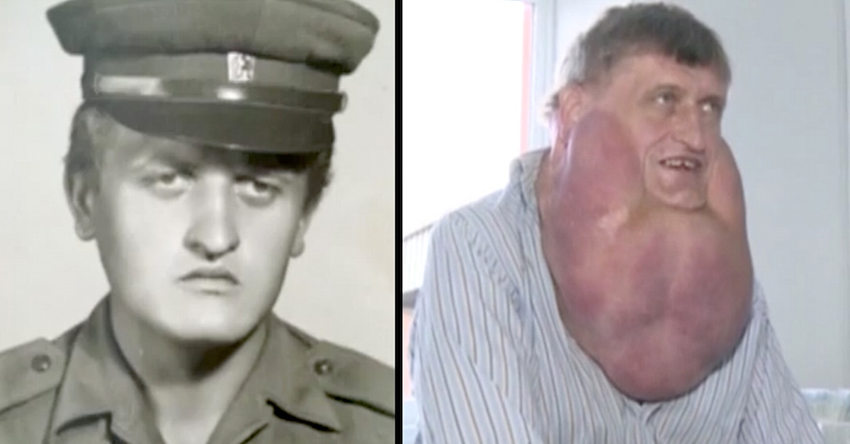 Man Notices His Jaw Is Growing At Bizarre Rate. 25 Years Later, He ...