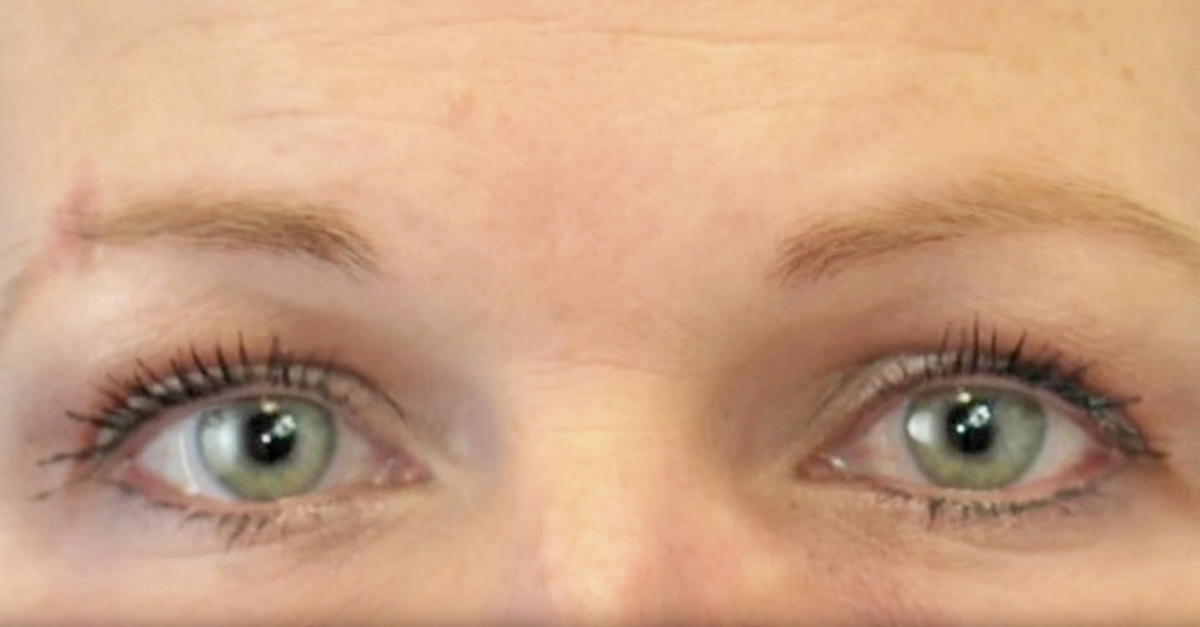 Mom Ignores Red Patch On Her Eyebrow For Years. When She Goes To Doctor ...