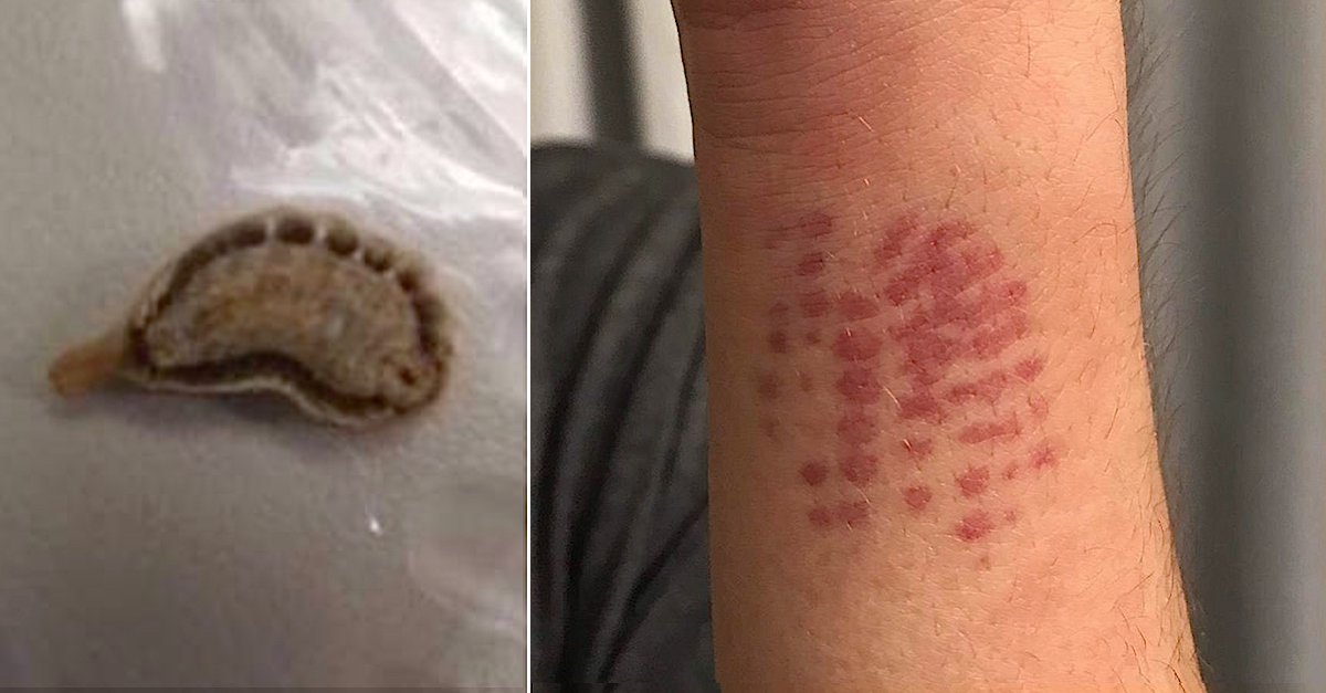 Mom Shares Warning After Teen Is Stung By Deadly Caterpillar ...
