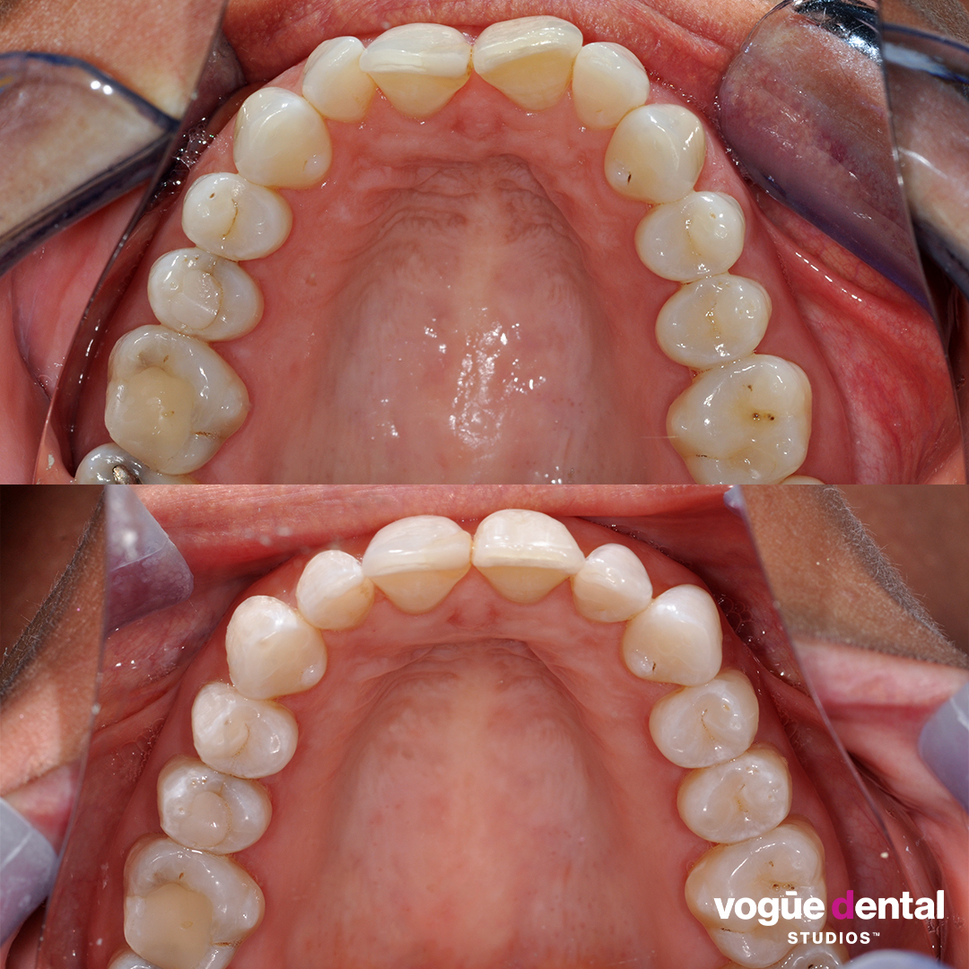 Invisalign Clear Aligners - Diamond Provider - Vogue Dental - Vogue ...