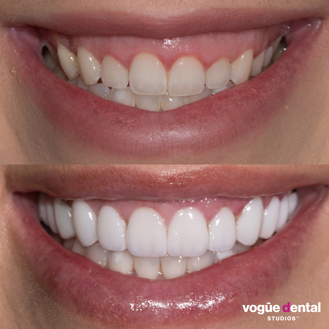 Picasso Porcelain Veneers® Before and After - LaurenH - Vogue Dental ...