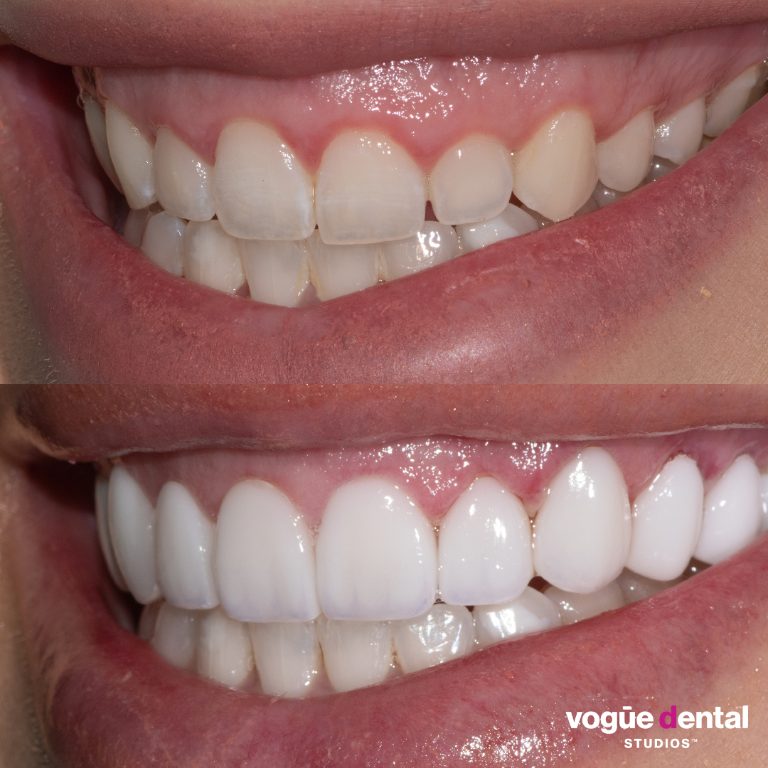 Picasso Porcelain Veneers® Before and After - LaurenH - Vogue Dental ...