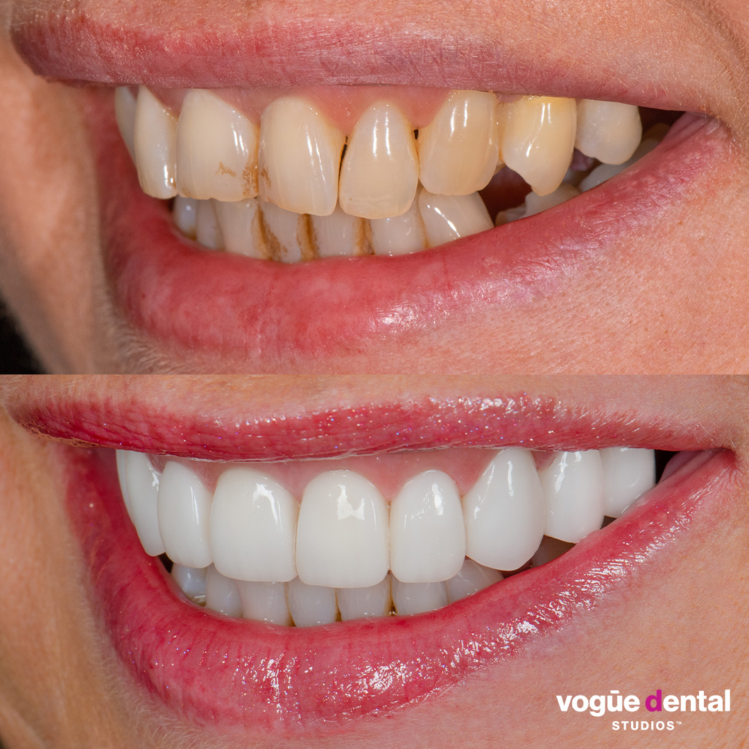 Picasso Porcelain Veneers® Before and After - Vogue Dental Studios