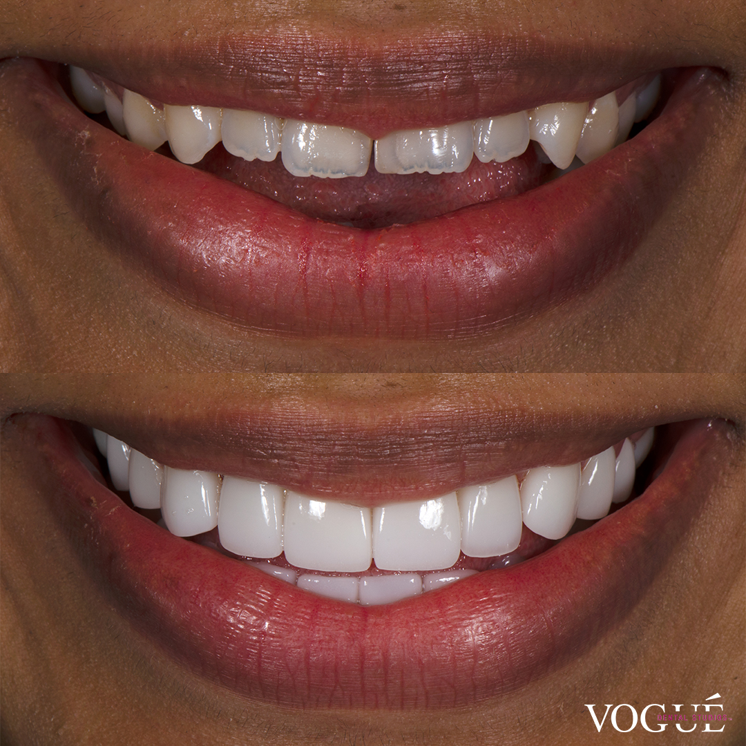 Porcelain Veneers and Smile Makeovers | Vogue Dental Studios