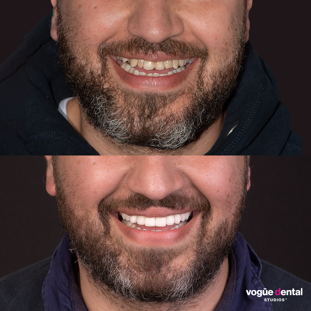 Picasso Porcelain Veneers® Before and After - Nick - Vogue Dental Studios