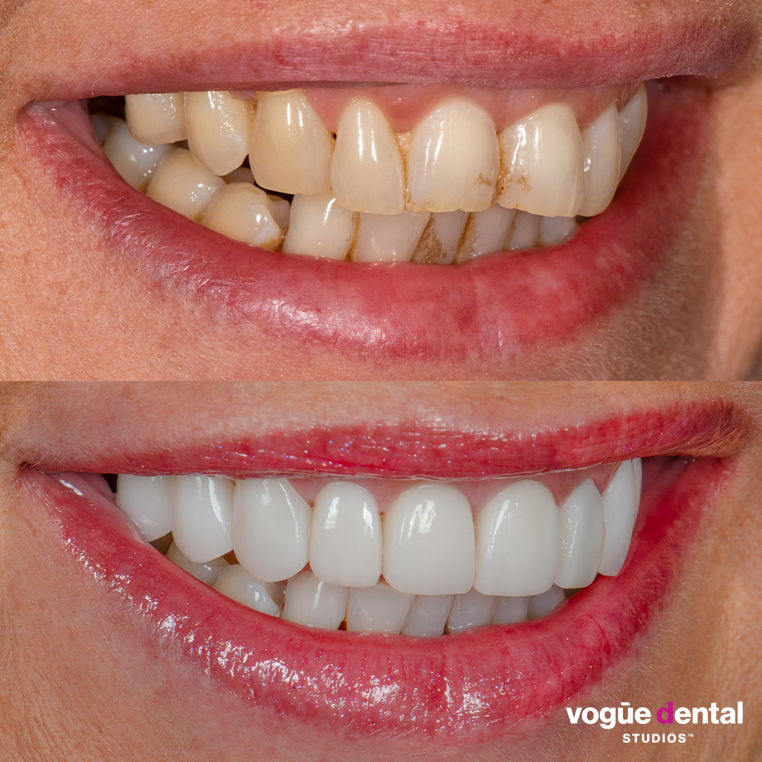 Picasso Porcelain Veneers® Before and After - Vogue Dental Studios