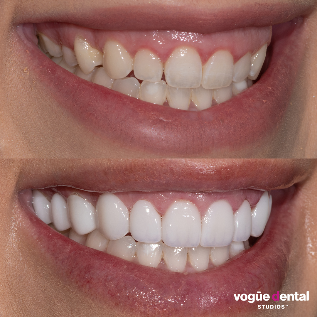 Picasso Porcelain Veneers® Before and After - LaurenH - Vogue Dental ...