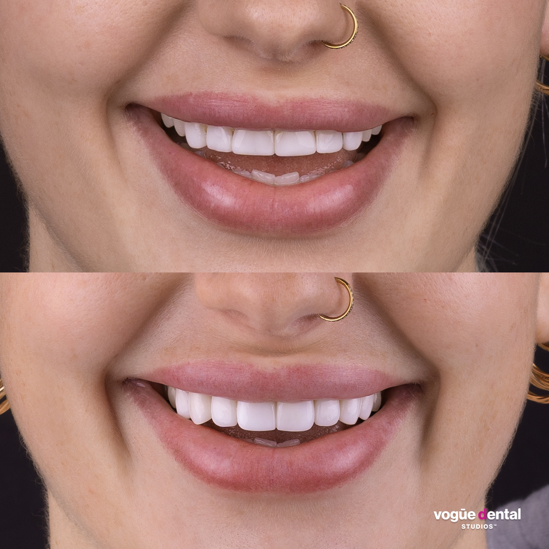 Picasso Porcelain Veneers® Before and After - Vogue Dental Studios