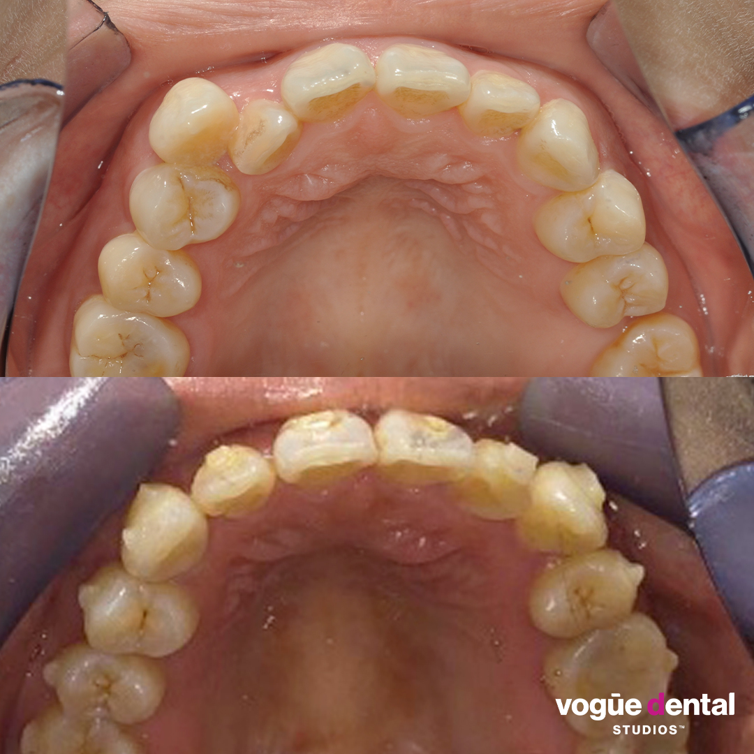 Invisalign Clear Aligners - Diamond Provider - Vogue Dental - Vogue ...