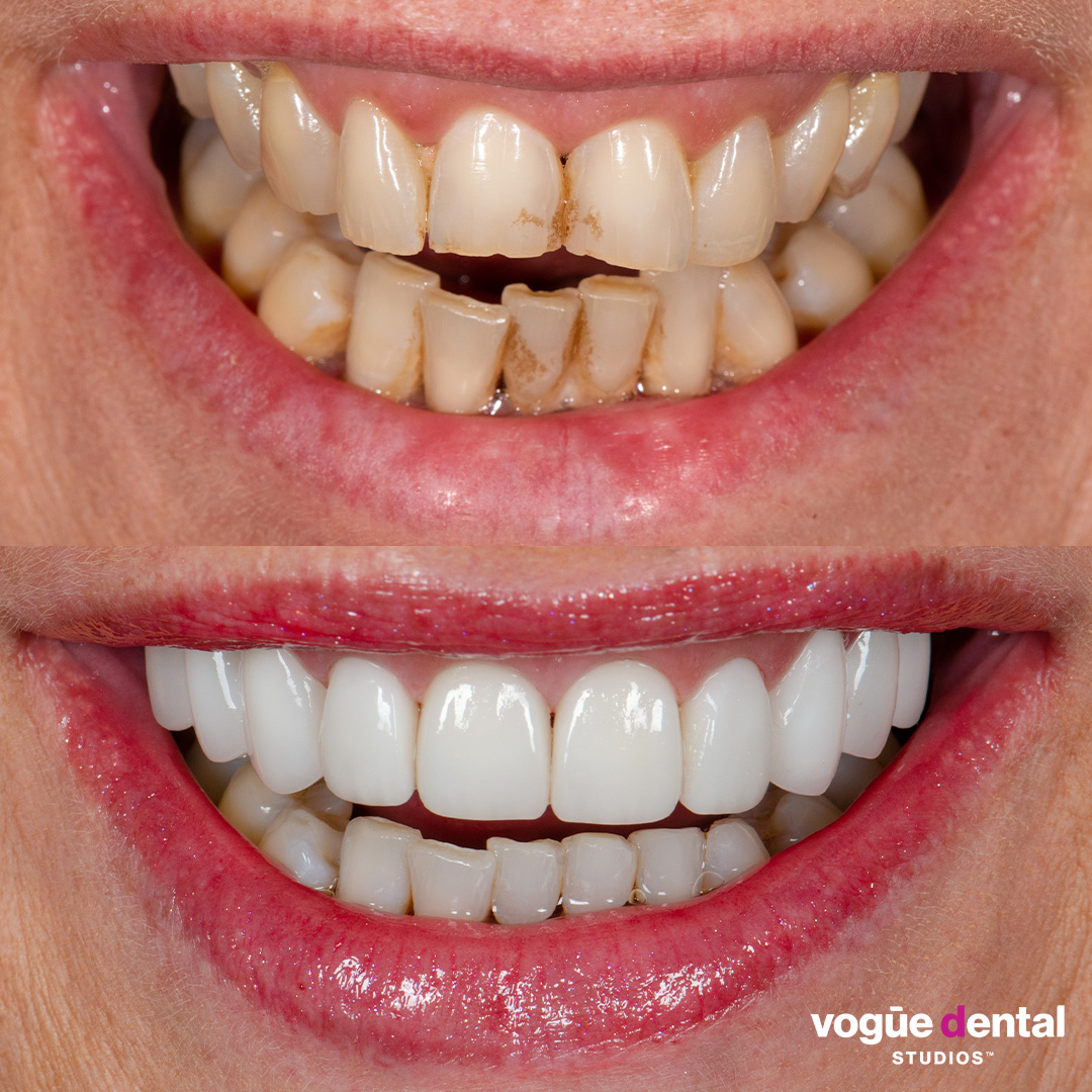 Picasso Porcelain Veneers® Before and After - Vogue Dental Studios