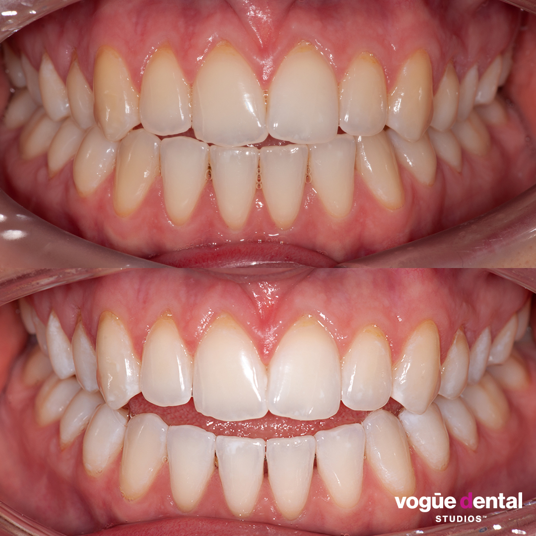 Before and After Gallery | Vogue Dental Studios