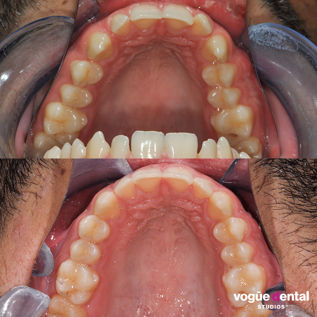 Invisalign Clear Aligners | Vogue Dental Studios