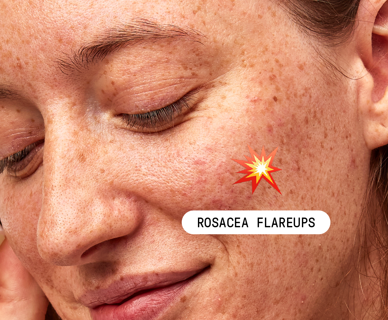 Rosacea Triggers: What Causes Your Flare Ups? | Apostrophe