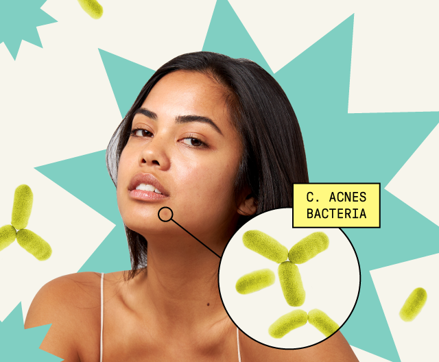 A Complete Guide To Using Tretinoin For Acne Apostrophe