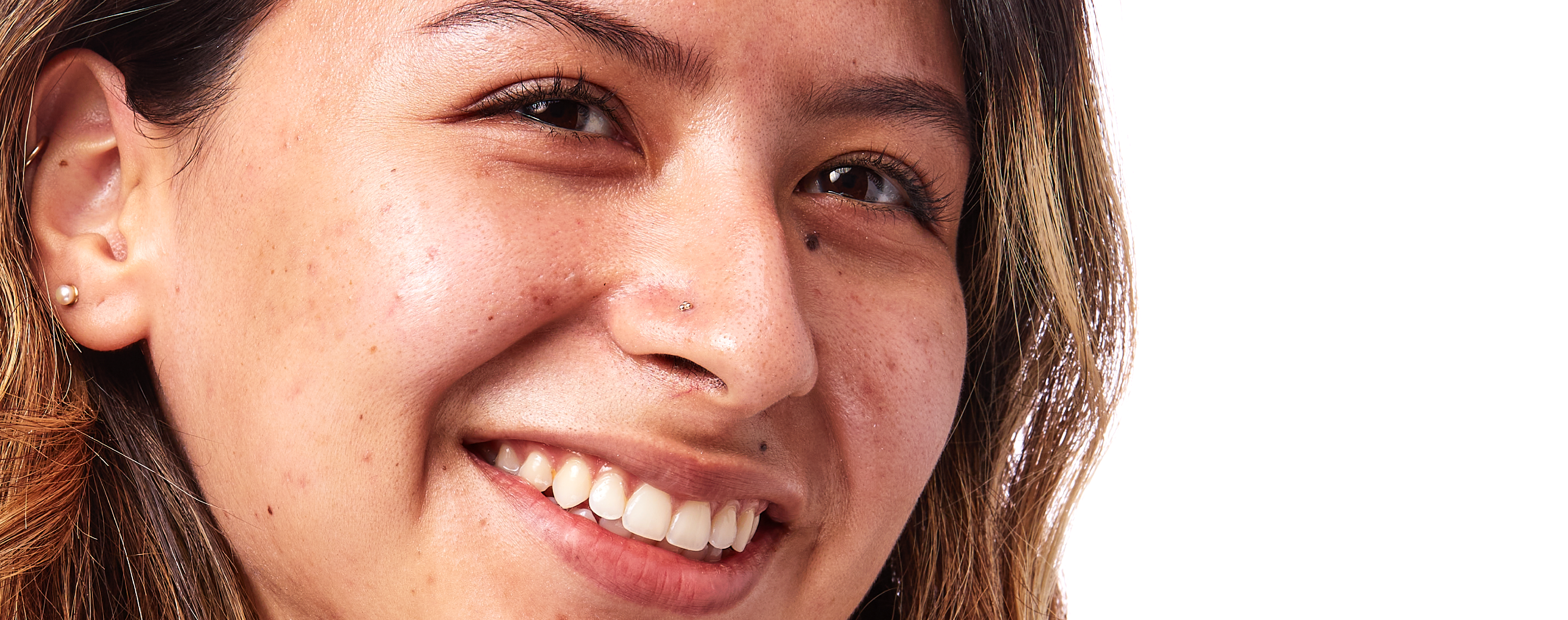 Does sugar cause acne?: How sweets affects your skin | Apostrophe