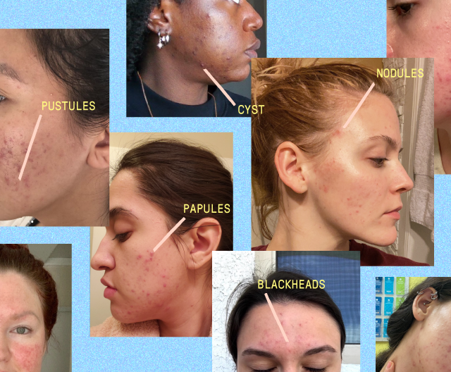 Acne Nodule Vs Cyst
