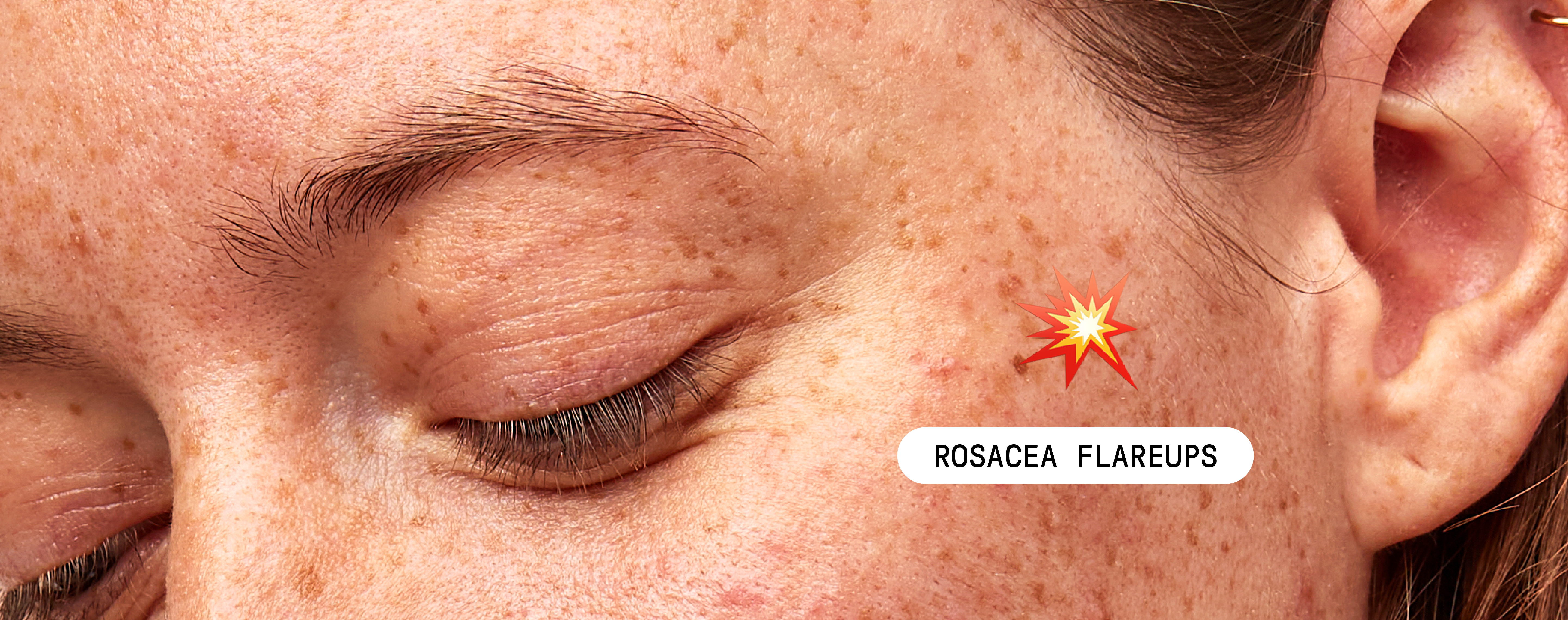 Rosacea Triggers: What Causes Your Flare Ups? | Apostrophe