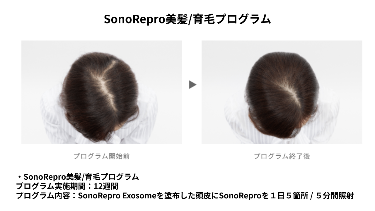 【SonoReproの使い方】超音波スカルプケアデバイスと美容液による髪の健康プログラム|ヘアケアラボ