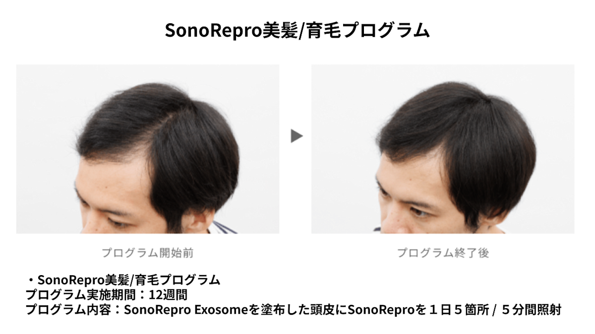 【SonoReproの使い方】超音波スカルプケアデバイスと美容液による髪の健康プログラム|ヘアケアラボ