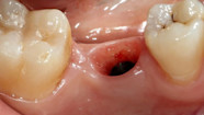 Gum Infection After Tooth Extraction
