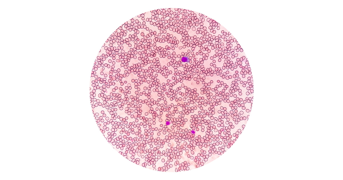 Itp Vs Ttp How These Platelet Disorders Differ