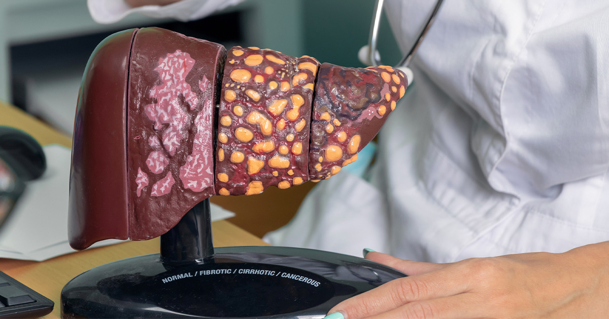 Understanding NASH: A Closer Look at the Stages