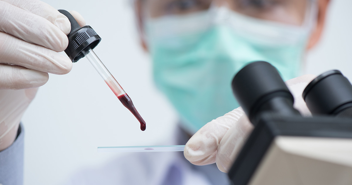 Understanding high IgA levels: Causes and impacts