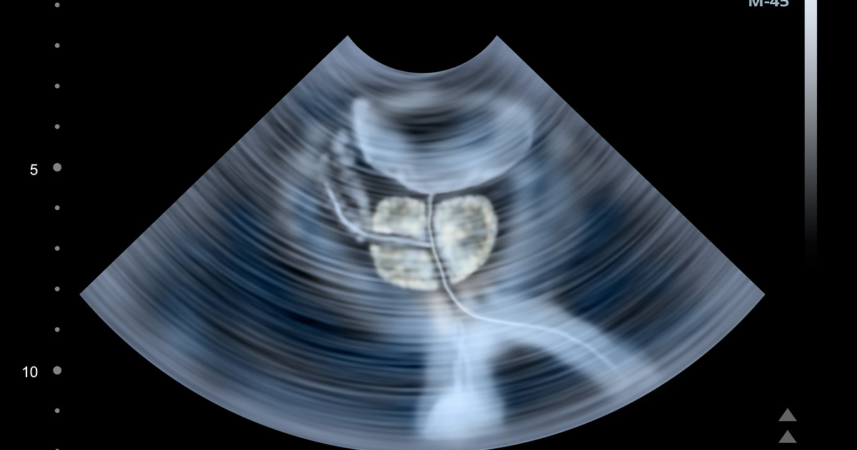 Prostate stones: Prevention and treatment