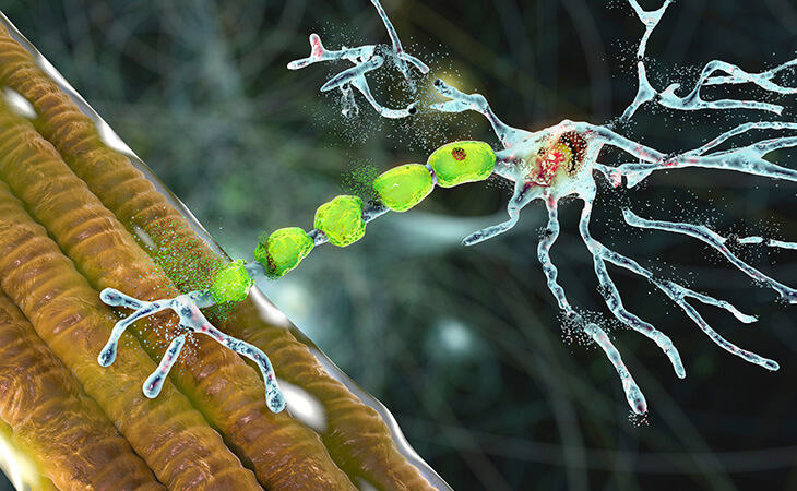 ALS causes and diagnosis