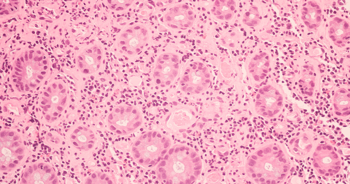 Understanding your breast cancer hormone receptor status: A guide for ...