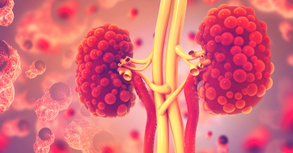 A guide to understanding ADPKD progression and disease stages
