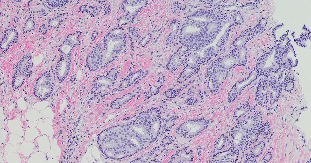 Navigating stage 4 HER2 negative advanced breast cancer