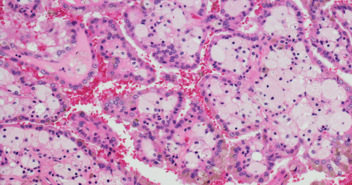 Papillary renal cell carcinoma: Risk factors, signs, treatment, & prognosis