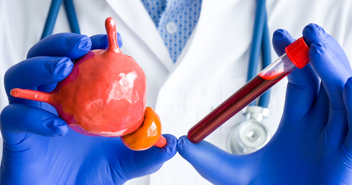 What causes PSA levels to rise and when to be concerned