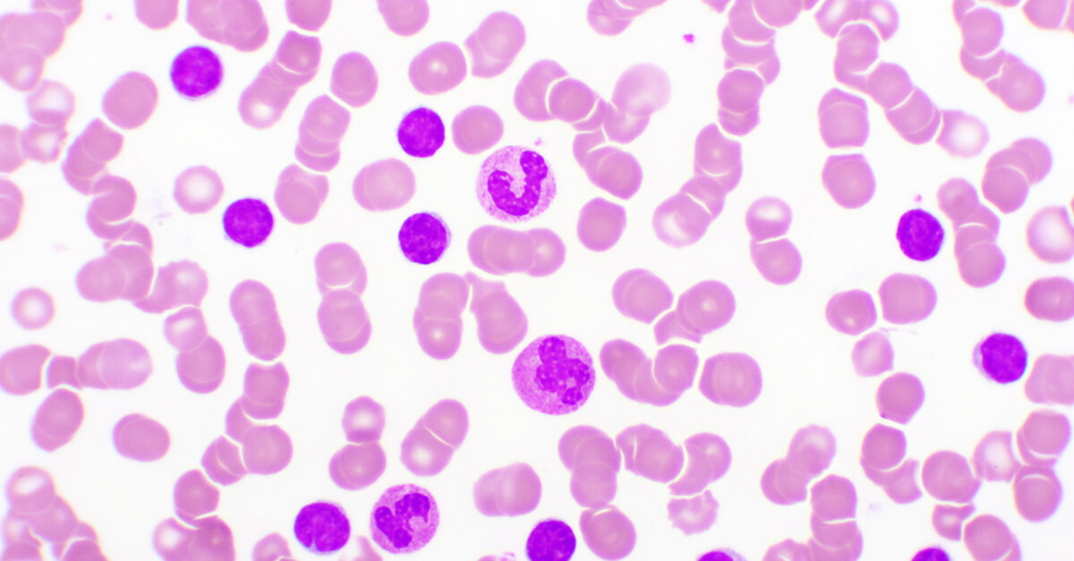 Leukemia