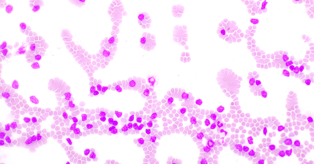 Chronic lymphocytic leukemia and small lymphocytic lymphoma