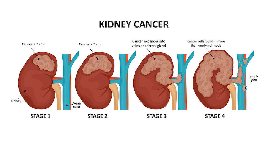 Kidney cancer stages