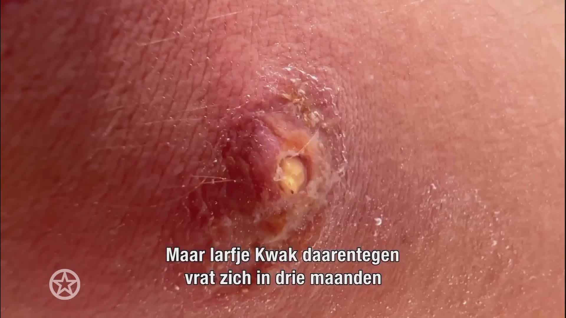 Horzel In De Huid